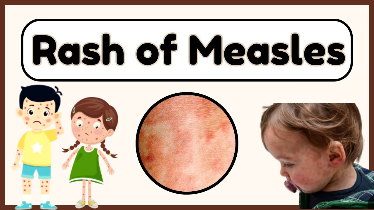 Rash of Measles and Koplik Spots | Signs of Measles - YouTube