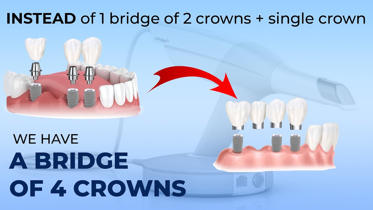 Instead of one bridge of two crowns and a single crown we have a bridge ...