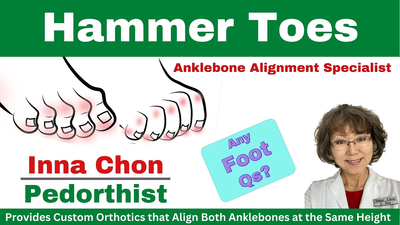 Hammer toes & Claw toes. How to get rid of the Cause to Prevent ...