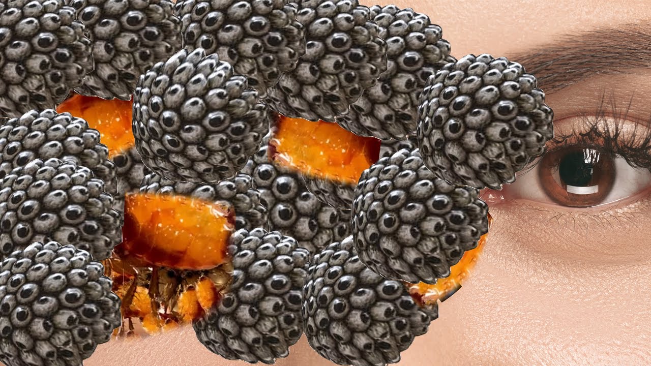 ASMR removal flaes & trypophobia infected EYE | ASMR EYE treatment ...