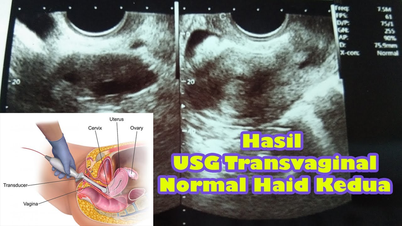 Hasil USG TV Normal Saat Haid Kedua - YouTube