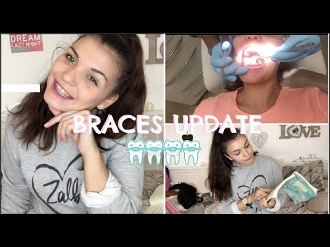 Braces Update! My wire snapped?! - YouTube