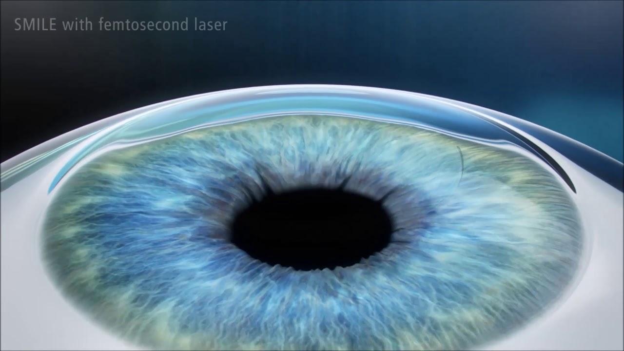 SMILE Procedure animation - YouTube