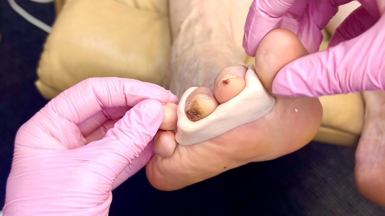 🦶 Custom Toe Prop Demo – Better Feet Silicone Orthosis | Real Case ...
