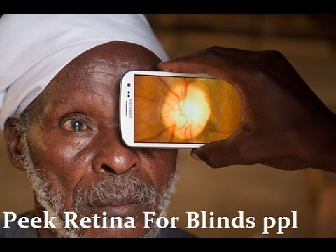 Peek Retina New Smartphone Eye Exam Tool for Blind ppl ,invention 2015 ...