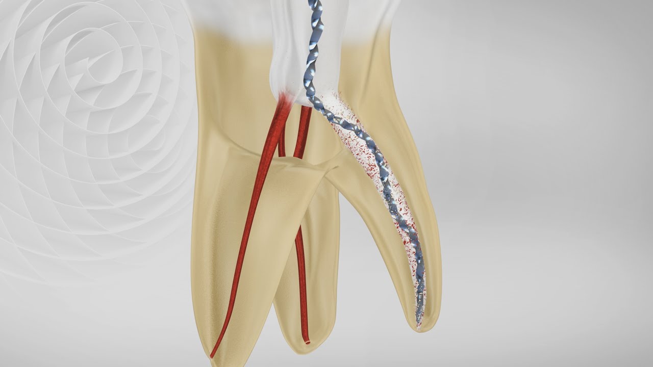 FKG XP-endo Shaper - English - YouTube