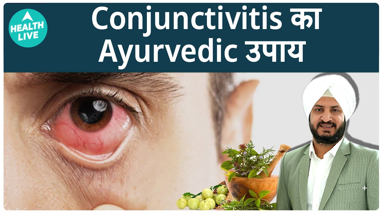 Natural Way Of Treating Conjunctivitis | Conjunctivitis Treatment ...