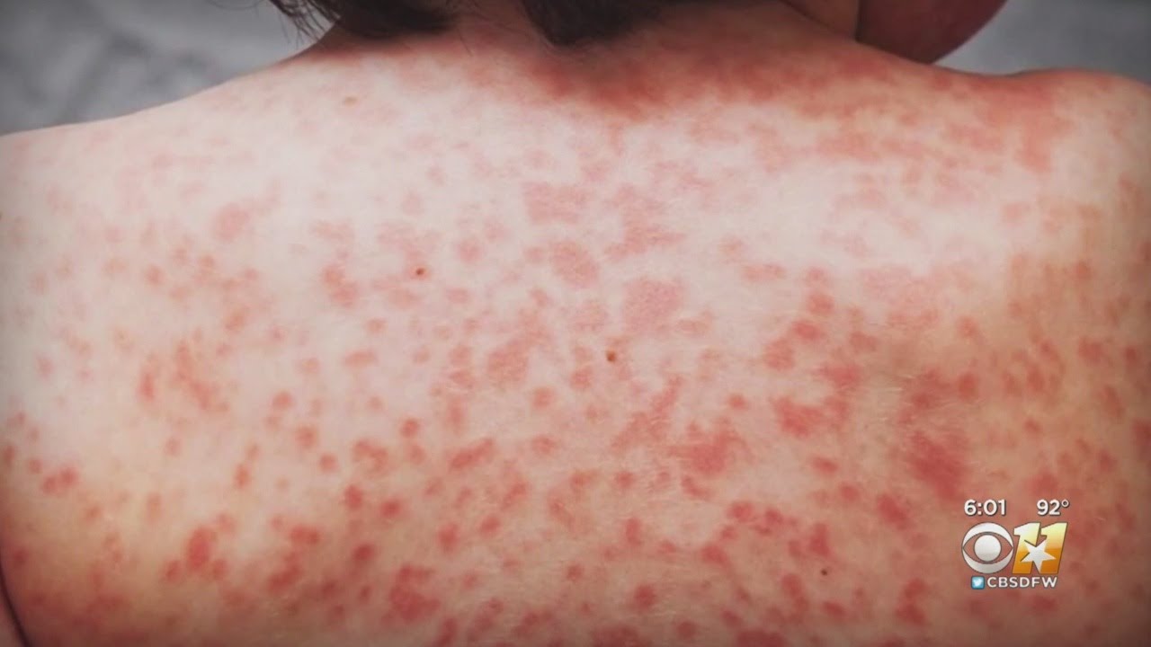 What Parents Need To Look Out For In Regard To Multisystem Inflammatory ...