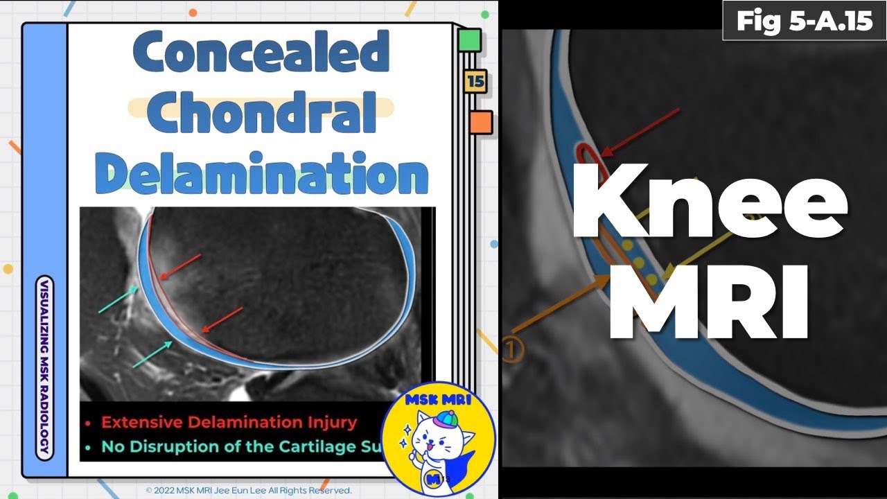 (Fig 5-A.15) Concealed Chondral Delamination - YouTube