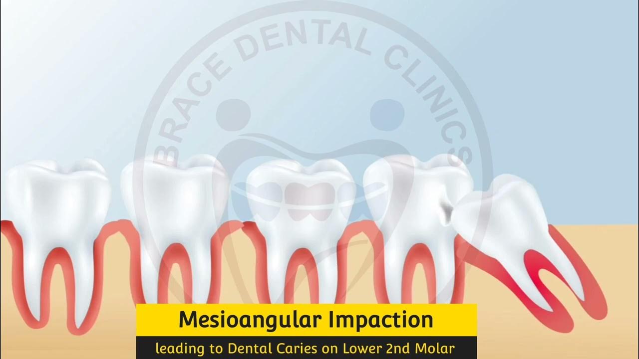 Mesioangular Wisdom Tooth Impaction -- Brace Dental Clinics - YouTube