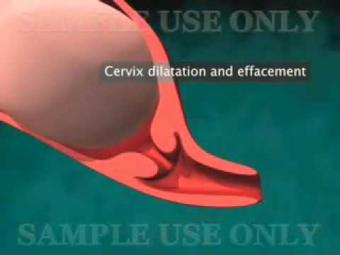MELAHIRKAN SECARA NORMAL ( NAISSANCE VAGINALE NORMALE )