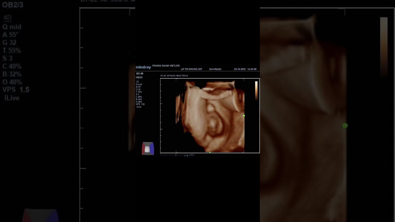 Mindray 4D Color Doppler Ultrasound Machine Dc39 4D Scan - YouTube