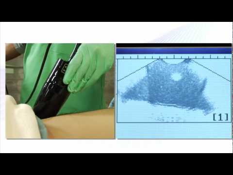 BioCon 500 Bladder Scanner Overview - YouTube