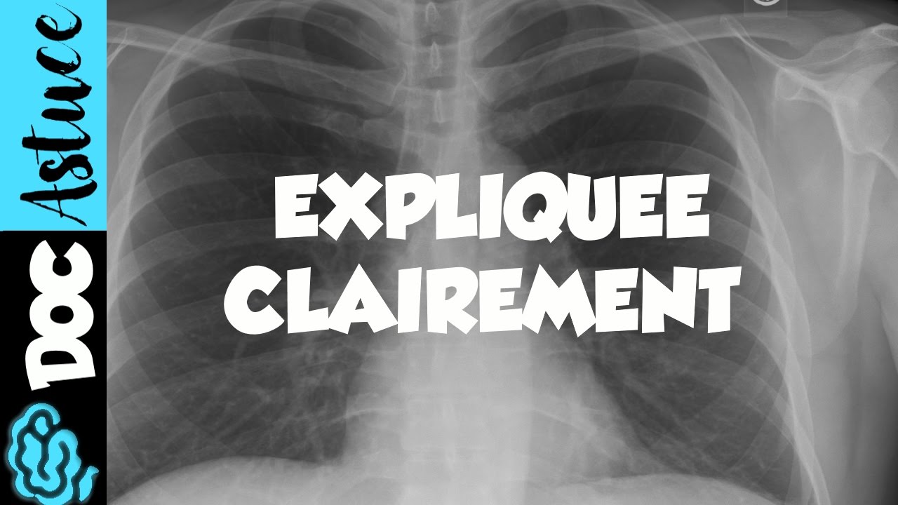 🔴 Dr Astuce - 3 ANOMALIES RADIO THORAX EXPLIQUÉES CLAIREMENT ! (PARTIE ...