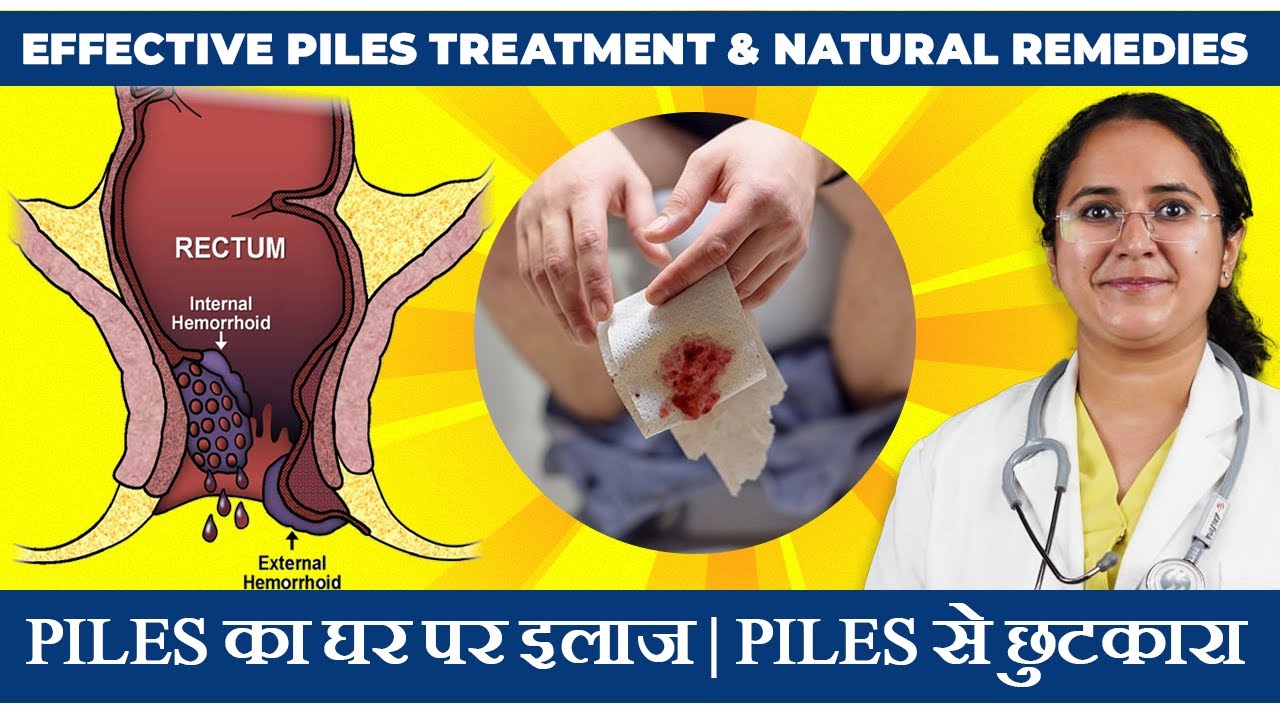 Piles Ka Ghar Bethe Ilaj: Tablets aur Natural Tips! - YouTube