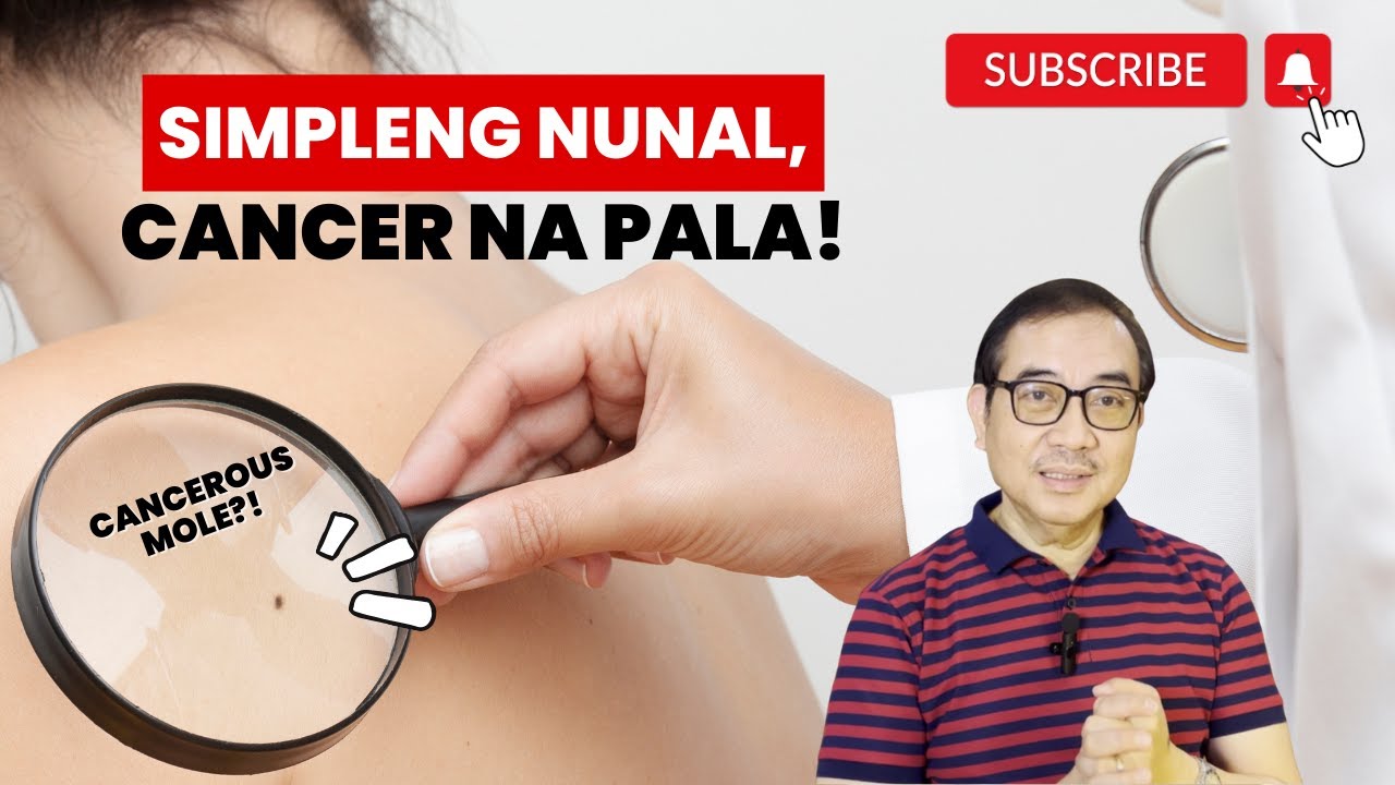 Simpleng WART o NUNAL pwede maging CANCER! | DR TONY LEACHON - YouTube