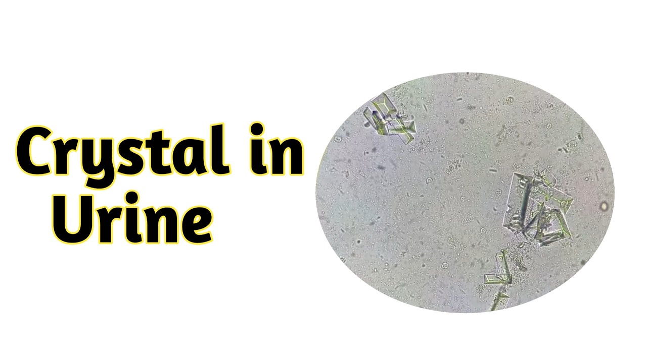 Dissolve Urine Crystals Toilet at Levi Skipper blog