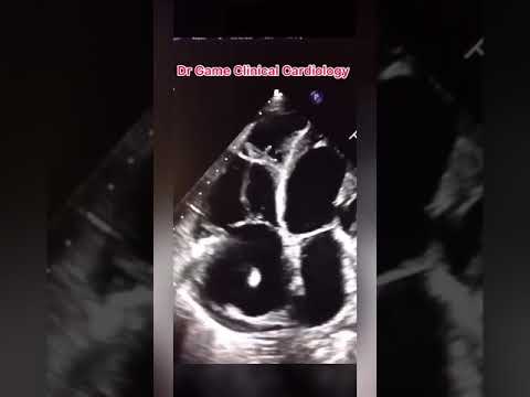 Right Heart Thrombus - Pulmonary Embolism - The Echo Channel - YouTube