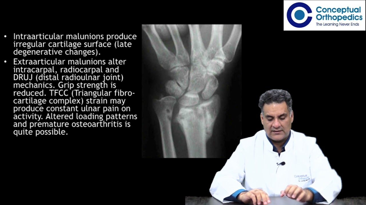 Malunited Distal end radius Fracture @Conceptual Orthopedics - YouTube