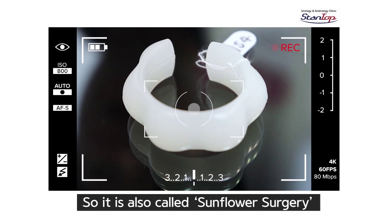 Penile Enlargement Surgery by silicone implants [Sunflower type ...