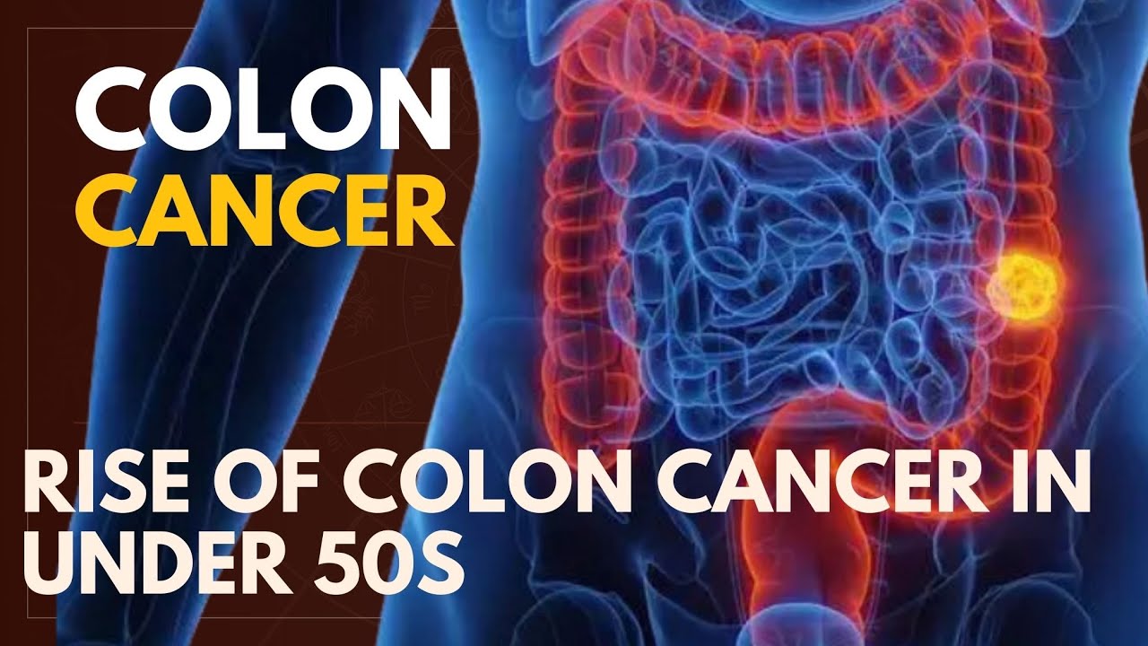 Unveiling the Rise of Colon Cancer in Under 50s: Understanding Its ...