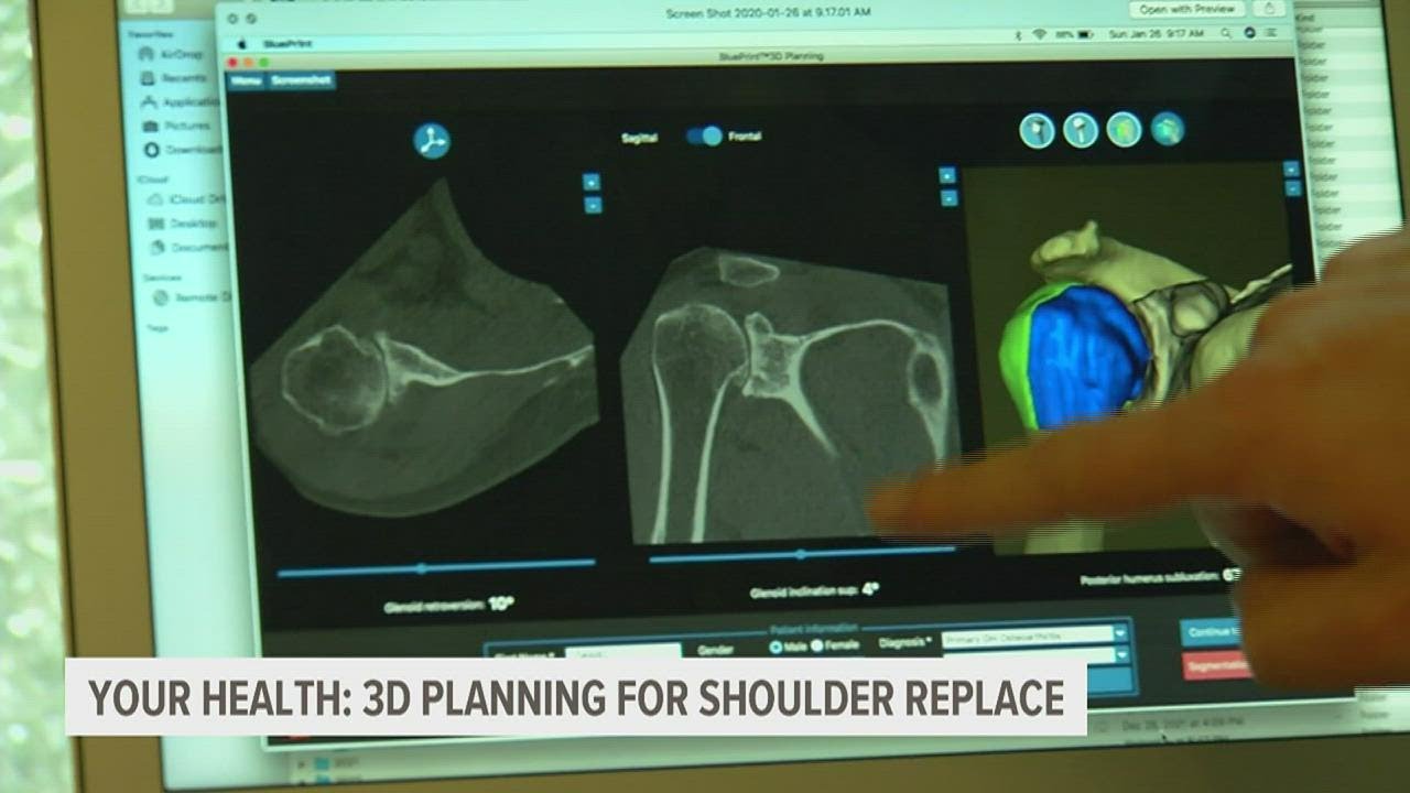 3D modeling means more personalized treatment for shoulder replacement ...