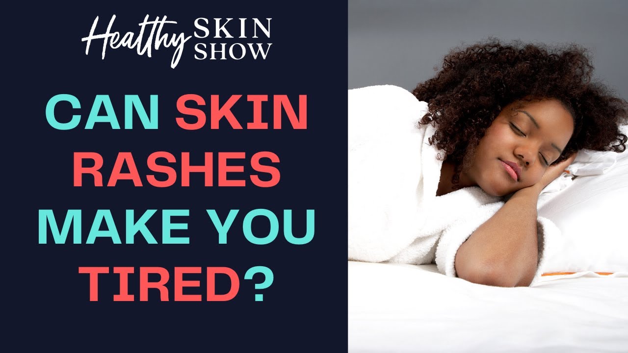 Can Skin Rashes Cause FATIGUE? | Jennifer Fugo - YouTube