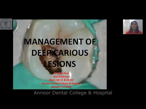 Management of DEEP CARIOUS LESION - YouTube