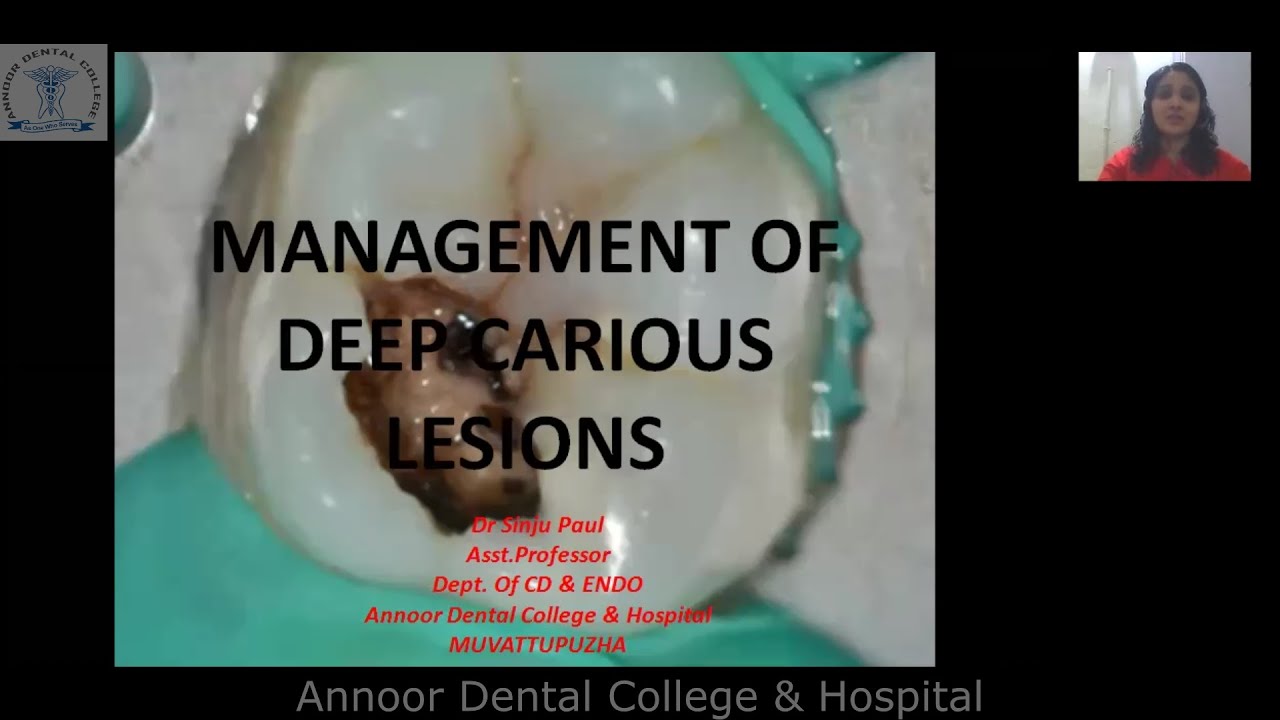Management of DEEP CARIOUS LESION - YouTube