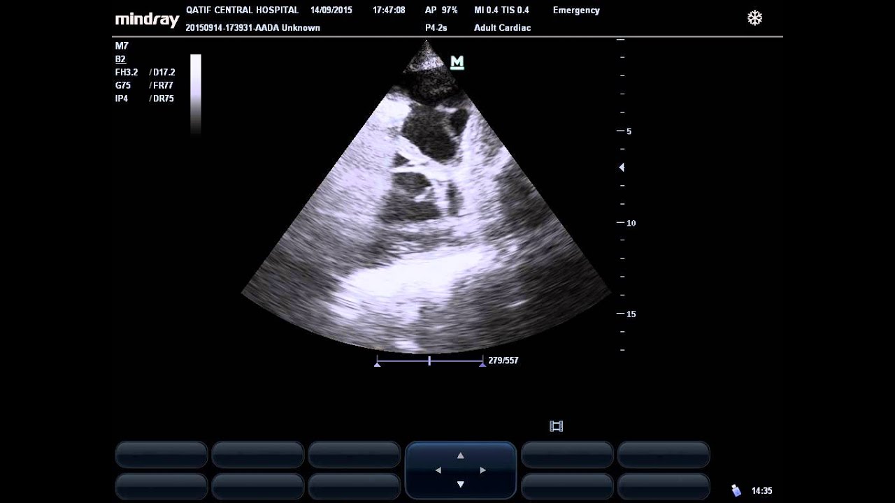 Synpneumonic exudative pleural effusion - YouTube