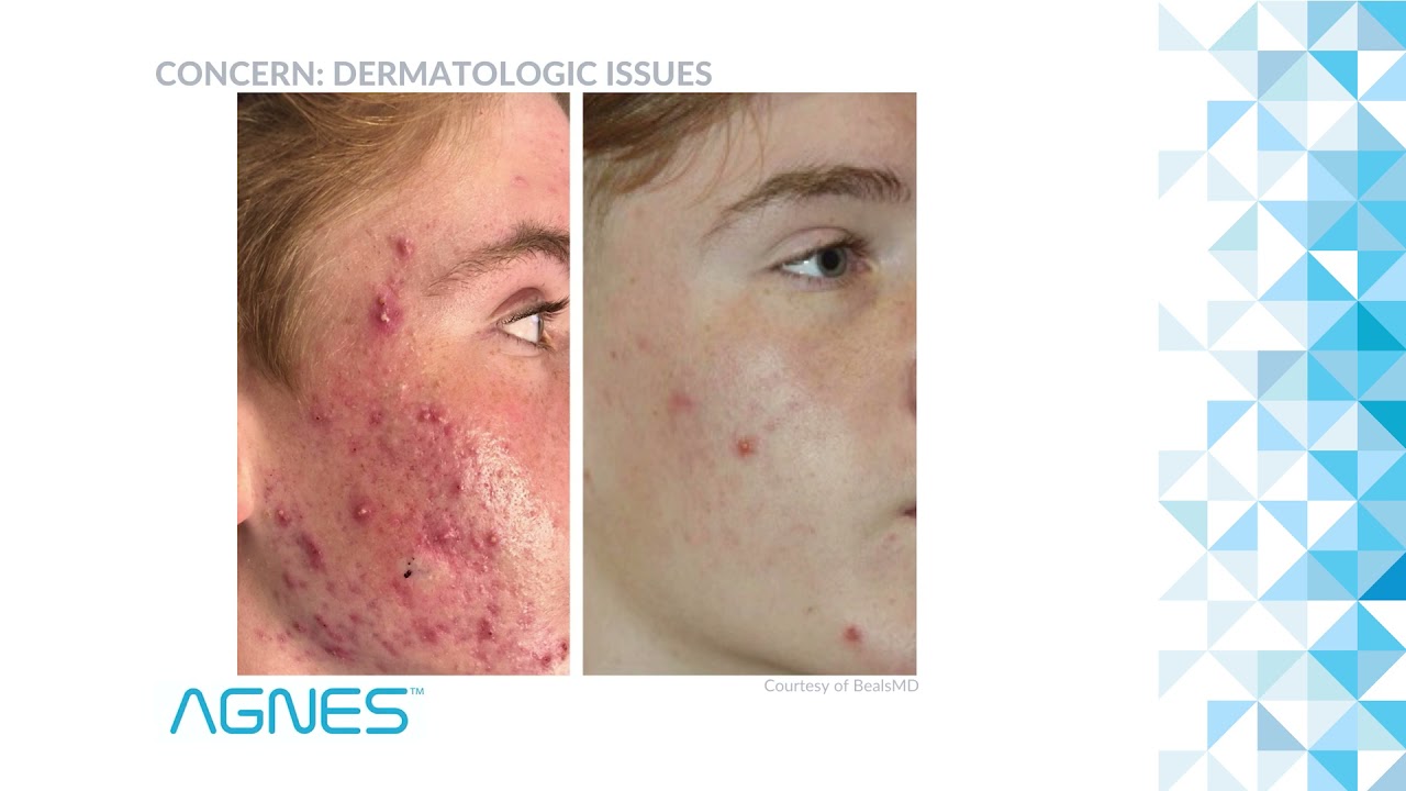 Agnes RF Before and After | QnA Cosmetic Surgery - YouTube