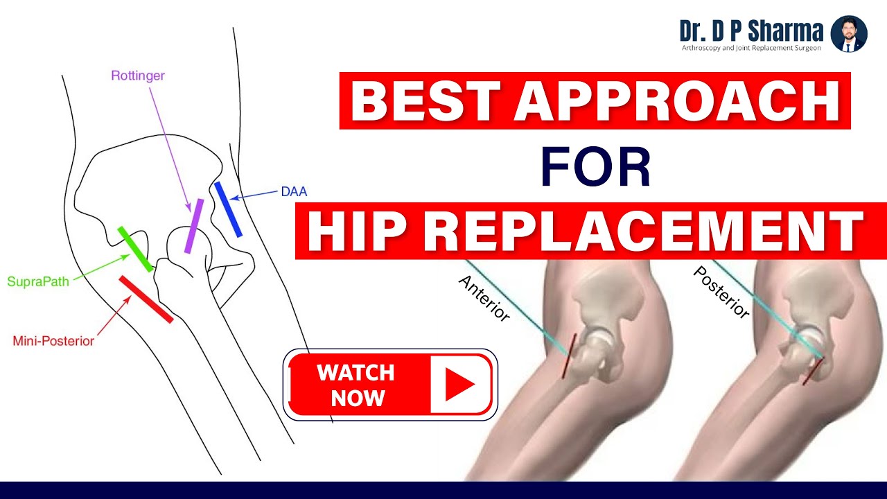 Know the Best Approach For Hip Replacement by 360-Degree Hip Surgeon in ...