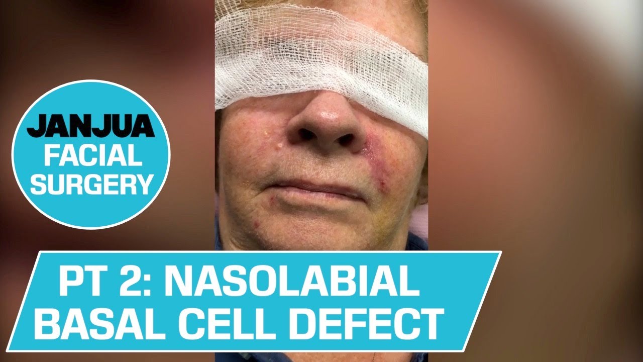 PART 2: NASOLABIAL BASAL CELL DEFECT - DR. TANVEER JANJUA - NEW JERSEY ...