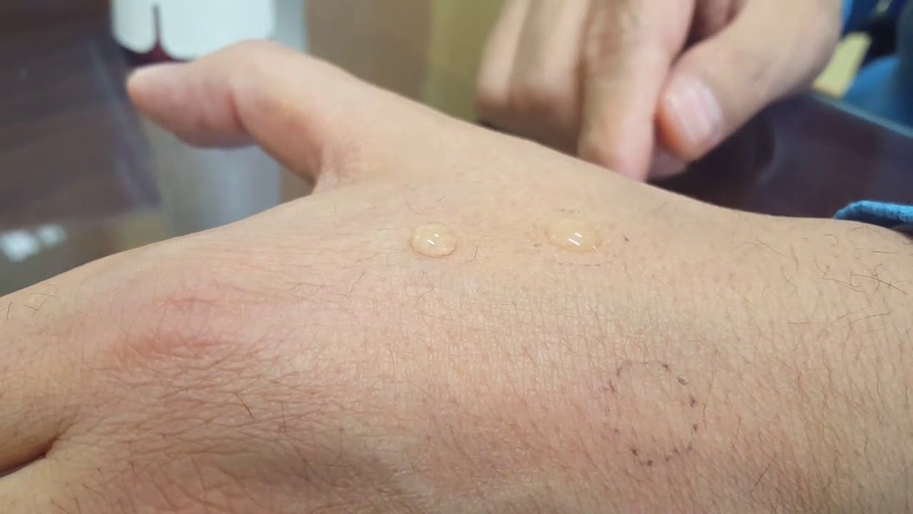 ACNO Plasma Shower TDDS Plasma Shower - YouTube