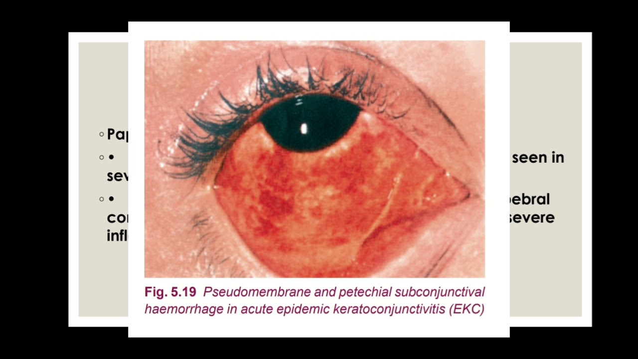 Viral conjunctivitis EKC - YouTube