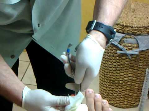 Doctor saca unero (JCL) 2013 - YouTube