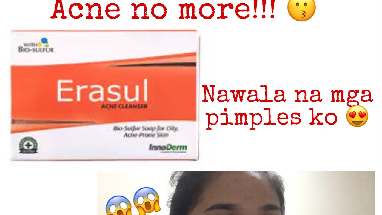 PAANO NAWALA TIGAYAWAT SA MUKHA?? USING ERASUL SOAP (SUPER EFFECTIVE ...