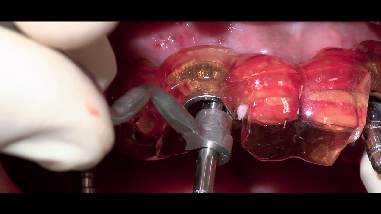 Straumann Pro Arch: Immediate full-arch restoration with 4 Straumann ...