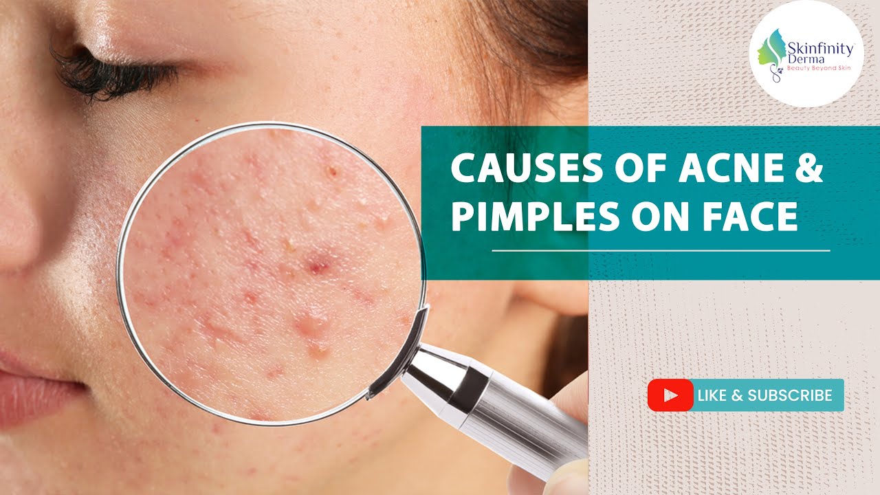 Here's What your Pimple is Trying to Tell You | Causes of Acne | Facial ...