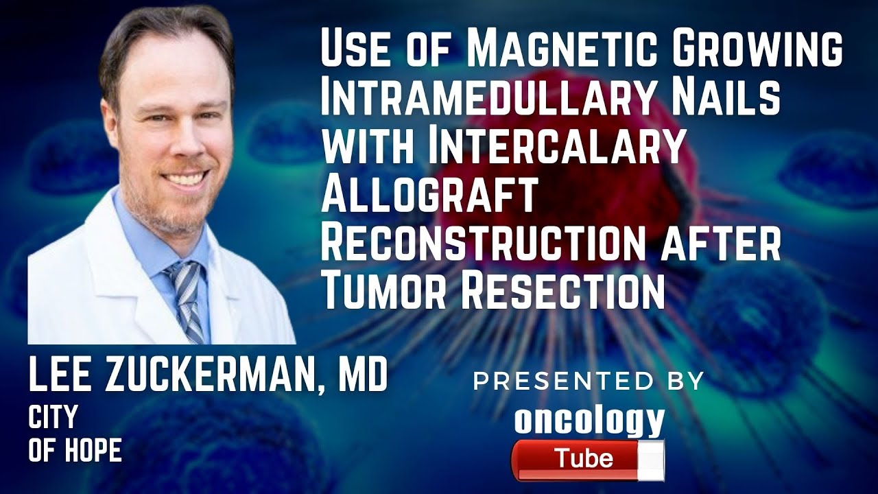 Magnetic Growing Intramedullary Nails w/Intercalary Allograft ...