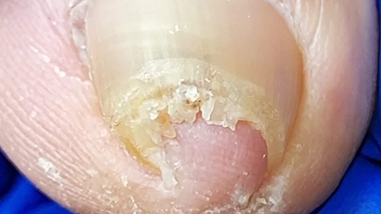 Amazing! Such curly ingrown nails【Xue Yidao】 - YouTube