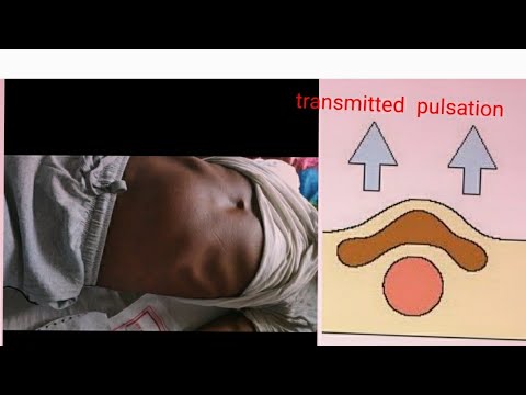 transmitted and expansile pulsation || Abdominal mass|| Transmitted ...