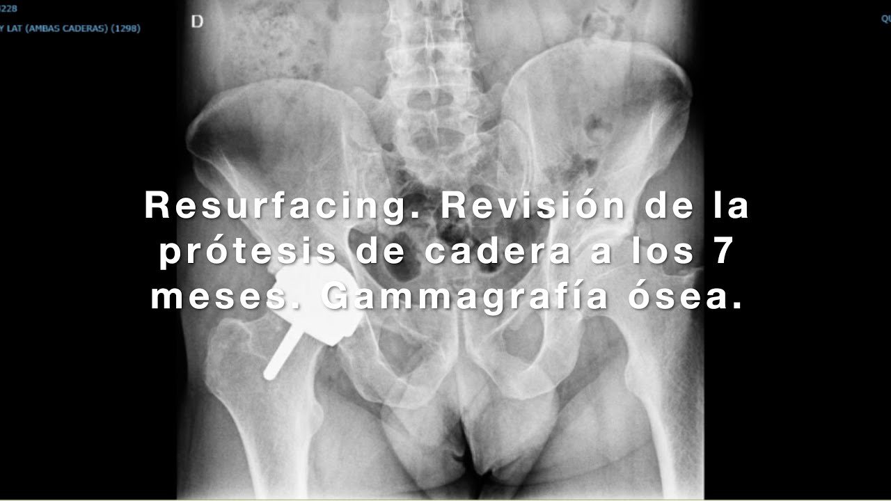 Resurfacing. Revisión de la prótesis de cadera a los 7 meses. Prueba ...