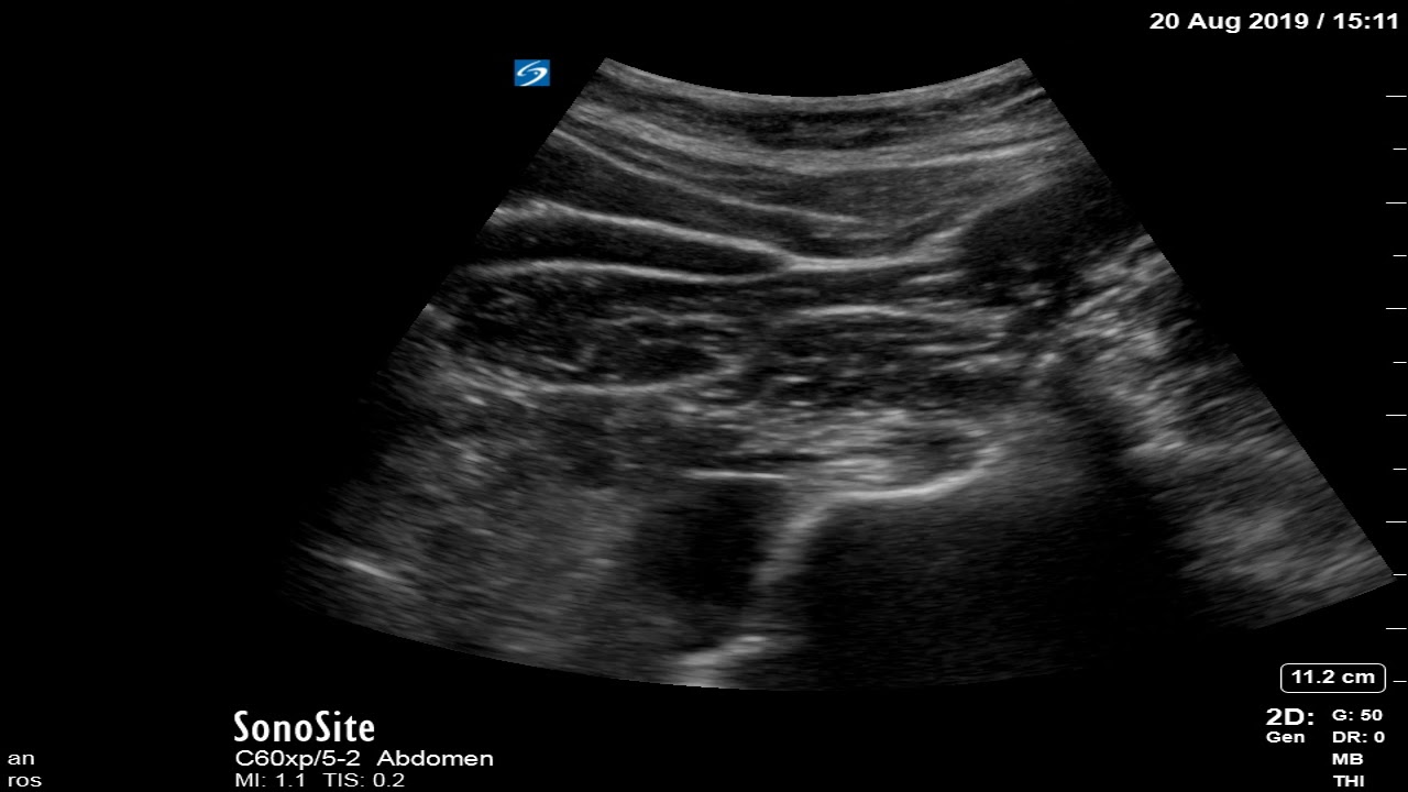 TQL block video. Respiratory movements prior to needle insertion. - YouTube