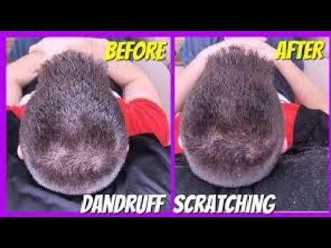 "ASMR Scalp TLC: A Relaxing Dandruff Treatment Animation" - YouTube