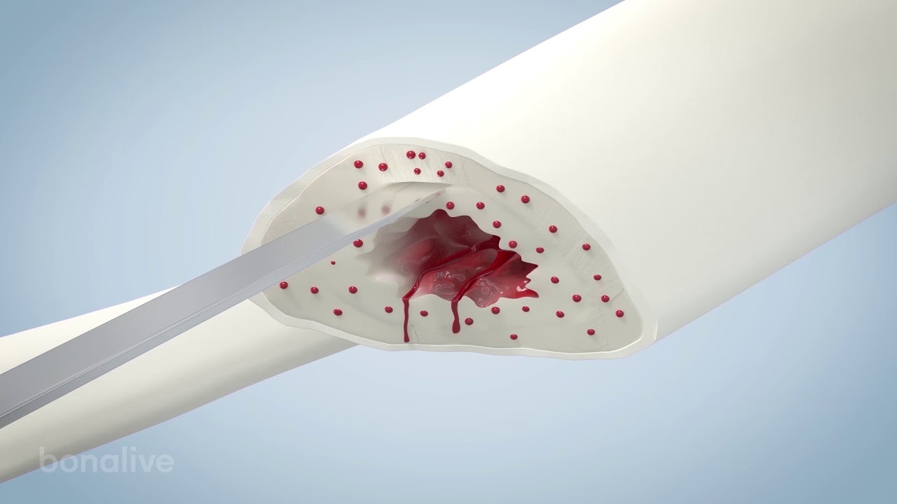 Bonalive® granules pour le traitement des pseudarthroses septiques ...