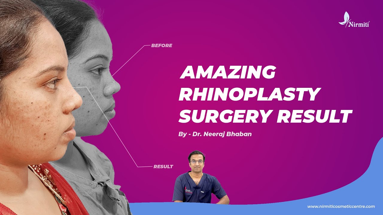 Nose Transformation Exploring Rhinoplasty with Dr. Neeraj Bhaban ...