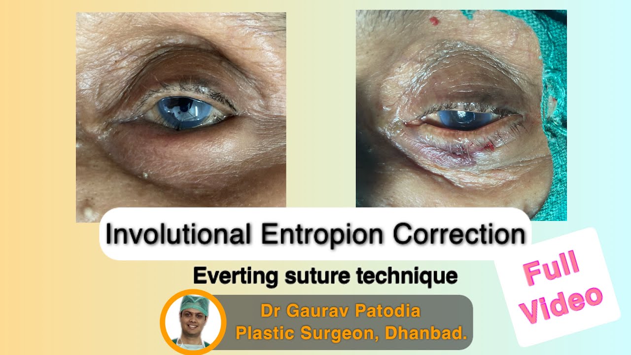 Entropion correction using the everting suture technique | Dr Gaurav ...