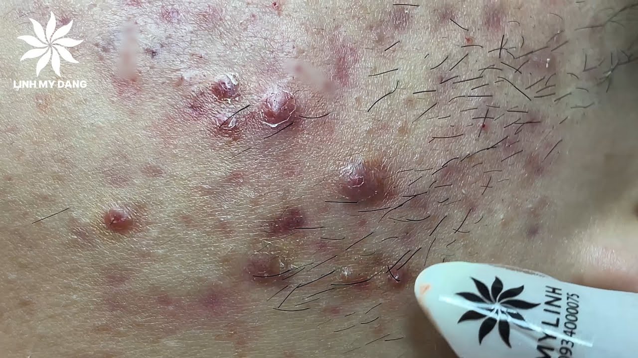 Relaxing Acne Treatment #7 | Inflamed Acnes - YouTube