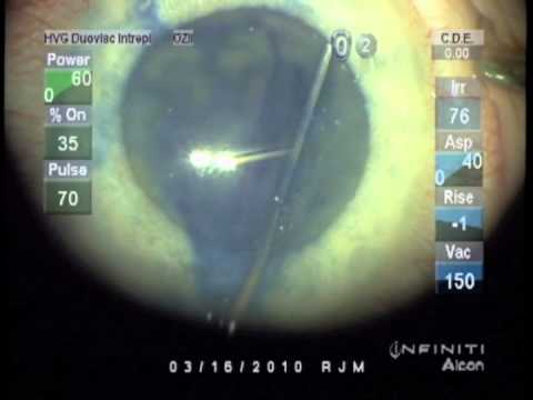 Pearls for Staining the Capsule: Applying Vision Blue - YouTube
